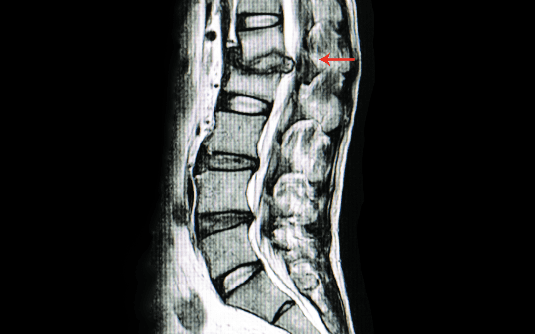 ¿Qué es la mielopatía cervical? Causas, síntomas y tratamiento?